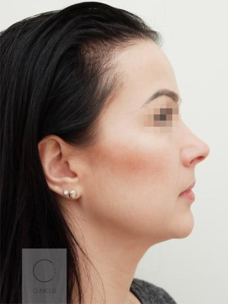 Cheeks (Bichat) fat removal - CLINICUS